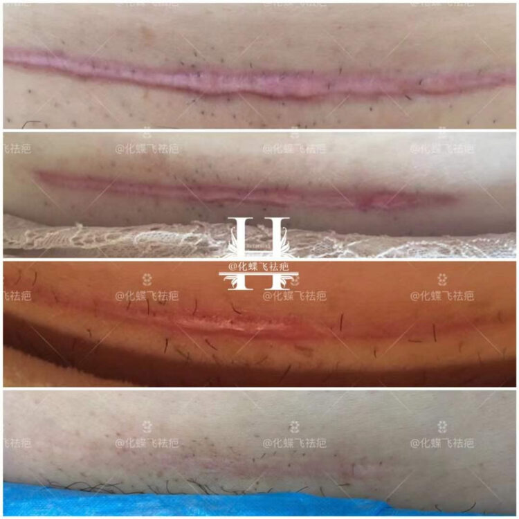 Cesarean Scar Healing And Long-Term Health: What Every Mother Should Know