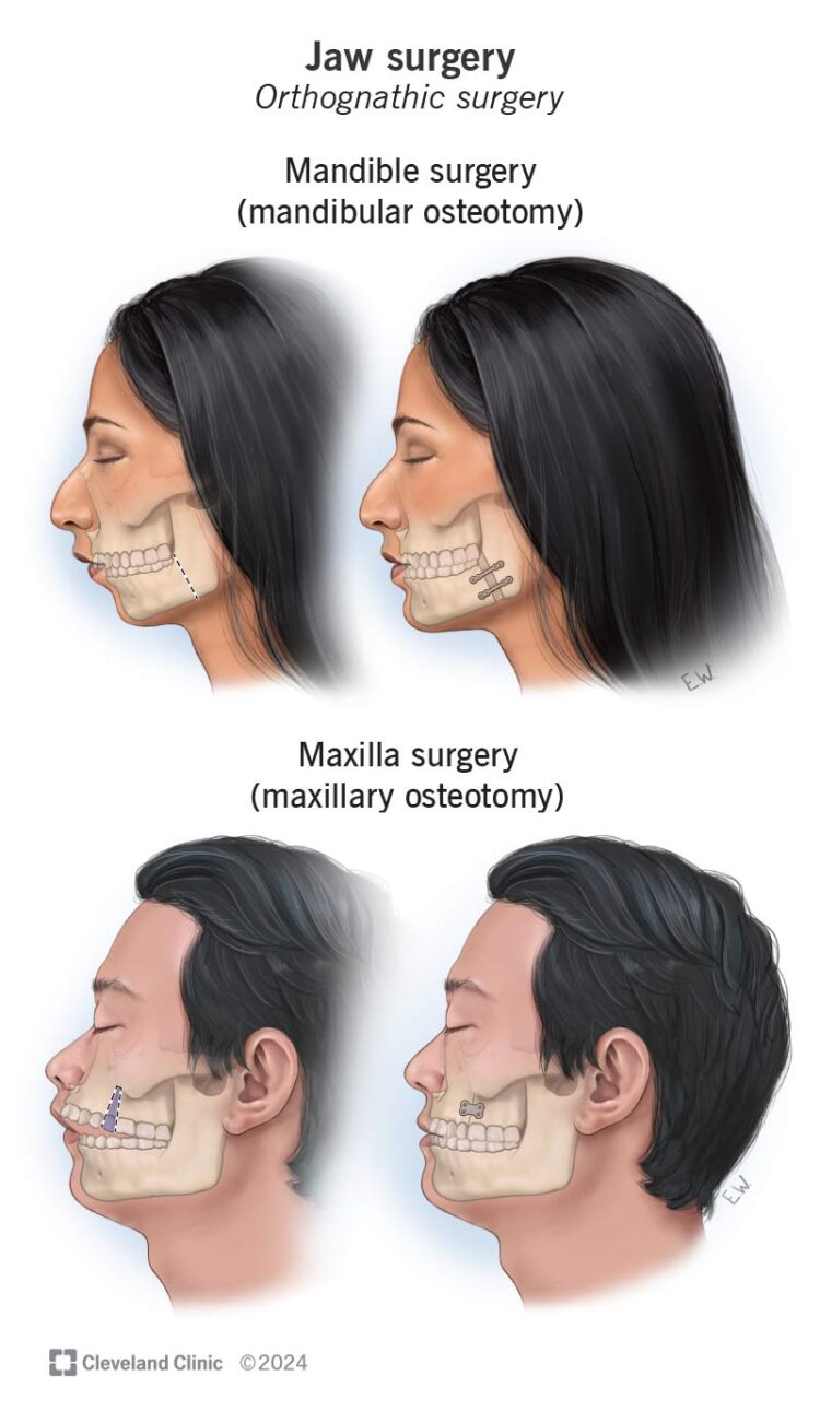 Chopped Chin: Causes, Diagnosis, Treatments, And Correction Options ...