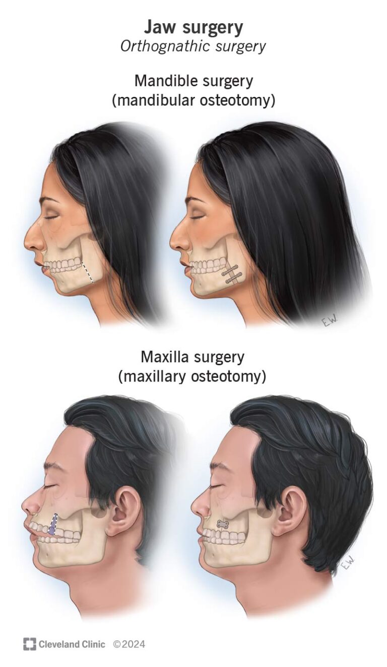 Chopped Chin: Causes, Diagnosis, Treatments, And Correction Options ...